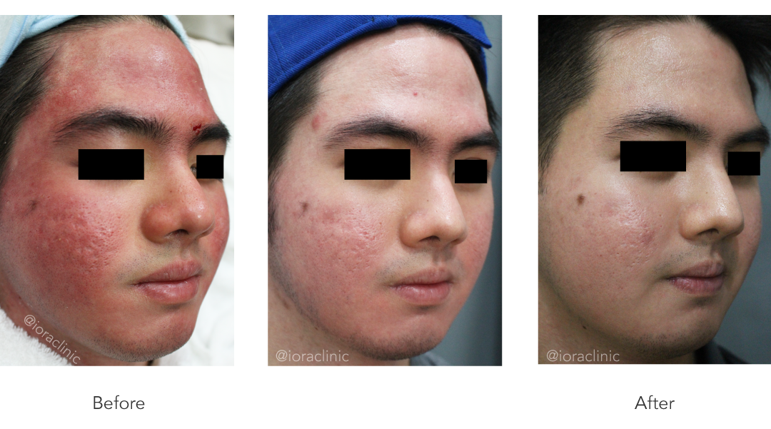 Penjelasan Rosacea - Jenis, Penyebab dan Cara Mengatasinya - Colederma