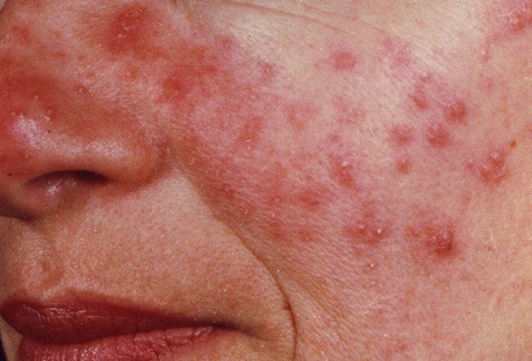 Penjelasan Rosacea - Jenis, Penyebab dan Cara Mengatasinya - Colederma