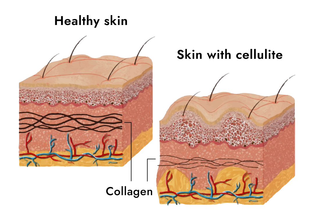 Cellulite - Definition, Causes, and Treatment - Colederma