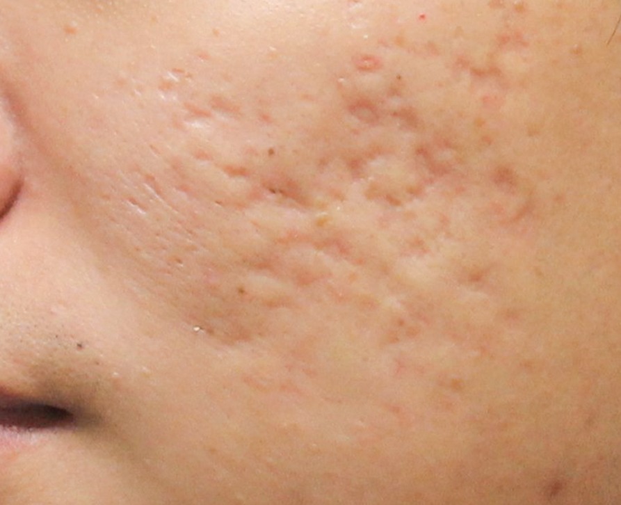 Identify Acne Scars, What's the Best Treatment? - Colederma
