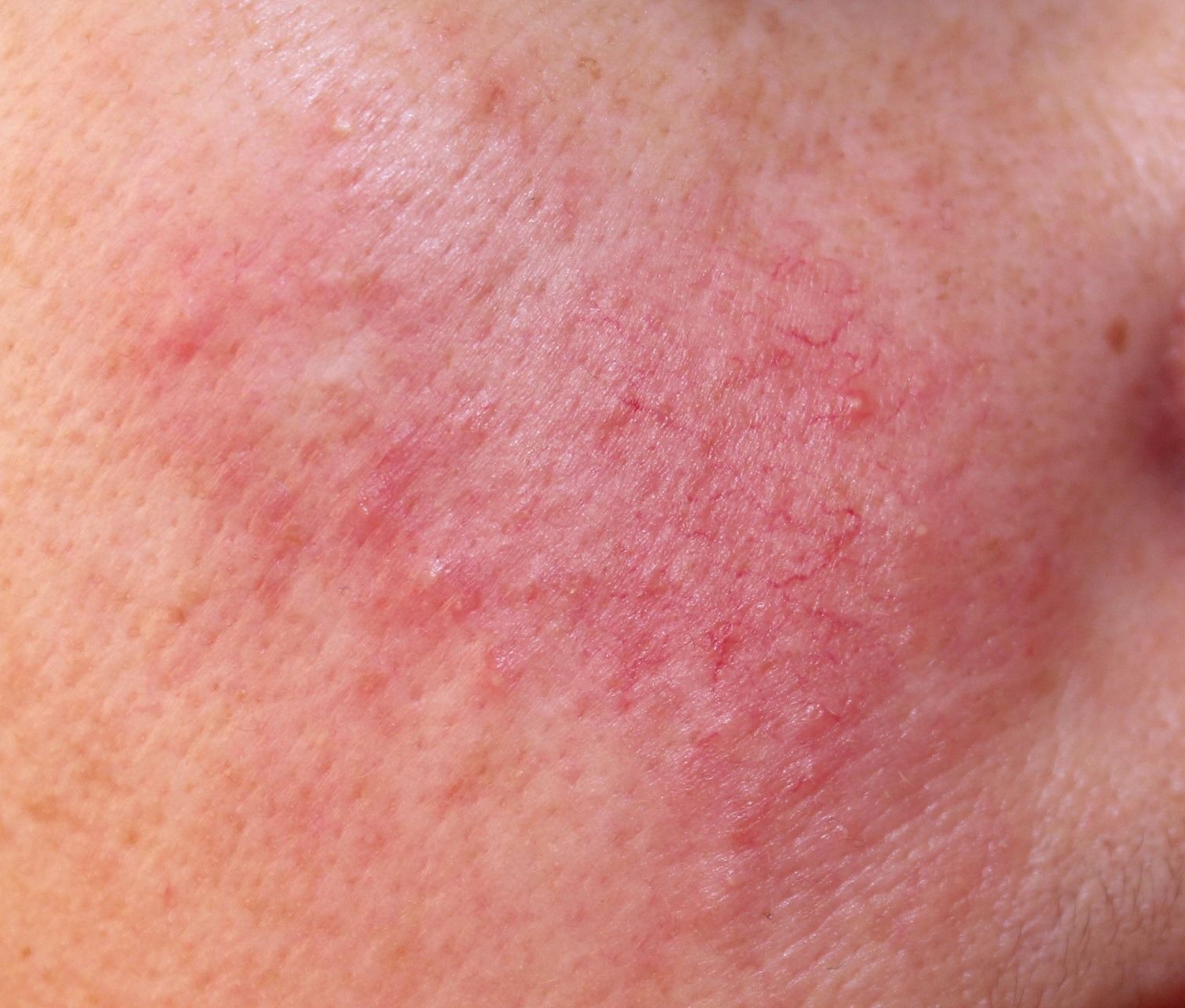 Rosacea: Causes, Types, and Treatments - Colederma