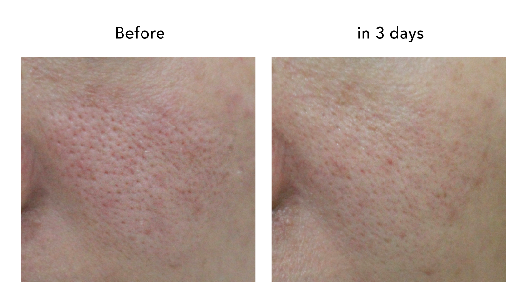 The Cause of Big Pores and How to Handle Them - Colederma
