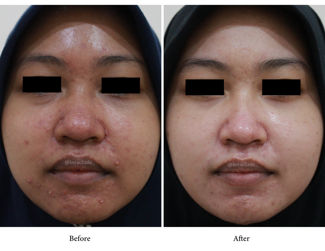 The Causes and Treatments of Dull Skin - Colederma