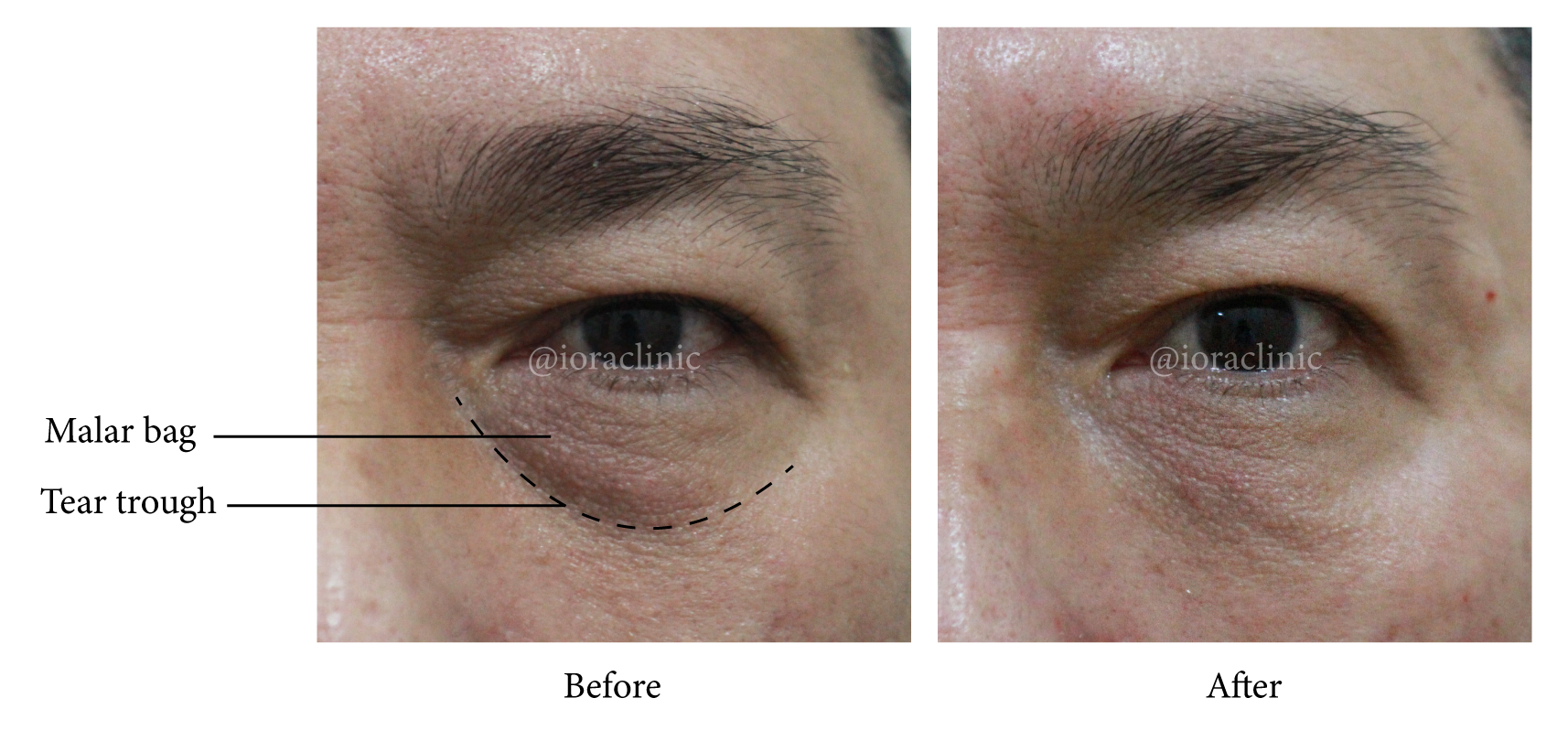 Definisi dan Cara Mengatasi Malar Bag hingga Tear Trough Deformity - Colederma