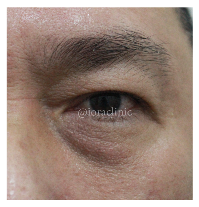 Definisi dan Cara Mengatasi Malar Bag hingga Tear Trough Deformity ...