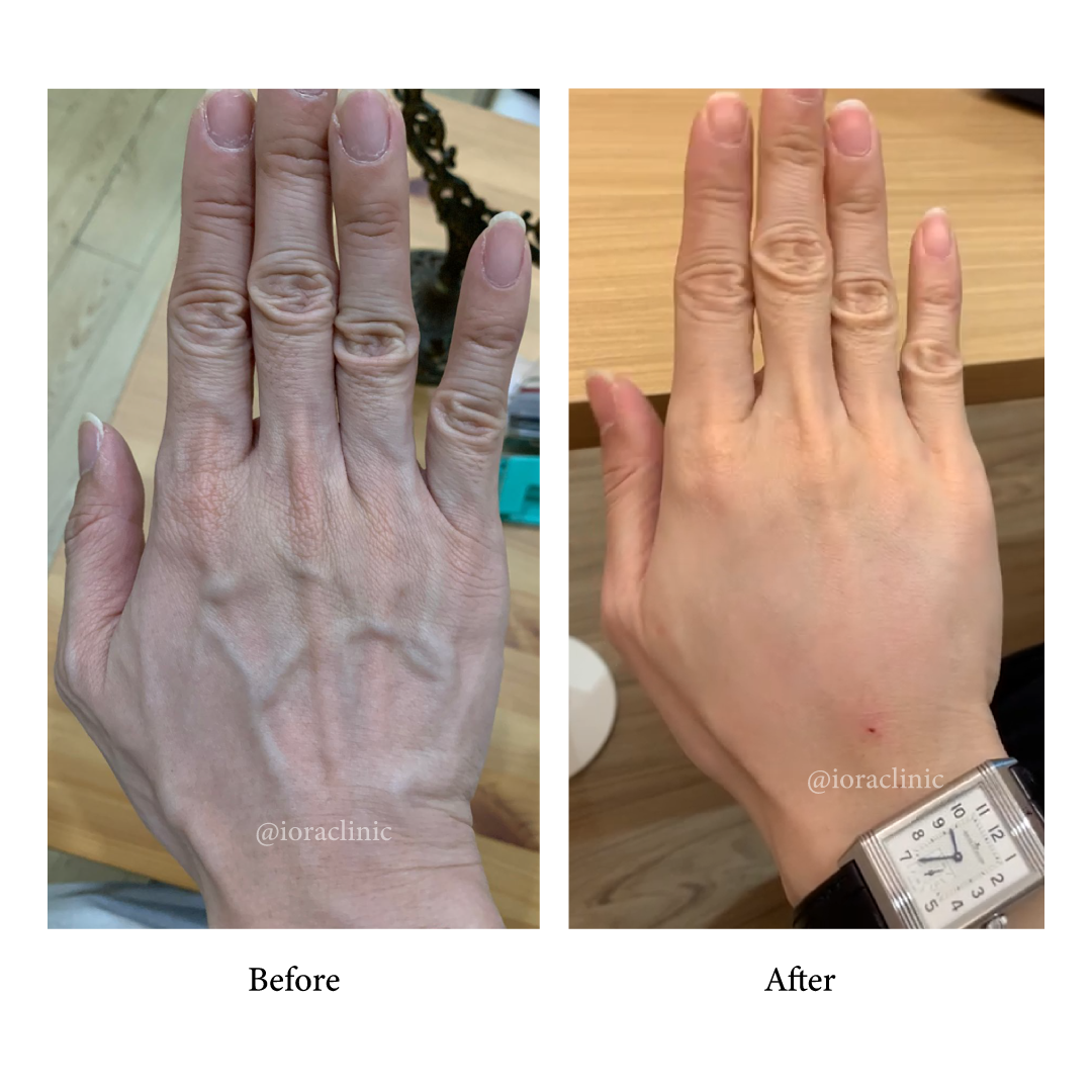 Kenali Penuaan Kulit Tangan dan Cara Mengatasinya - Colederma