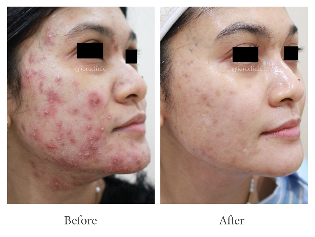 Makanan Manis Bikin Jerawatan dan Penuaan Kulit? Berikut Penjelasannya ...