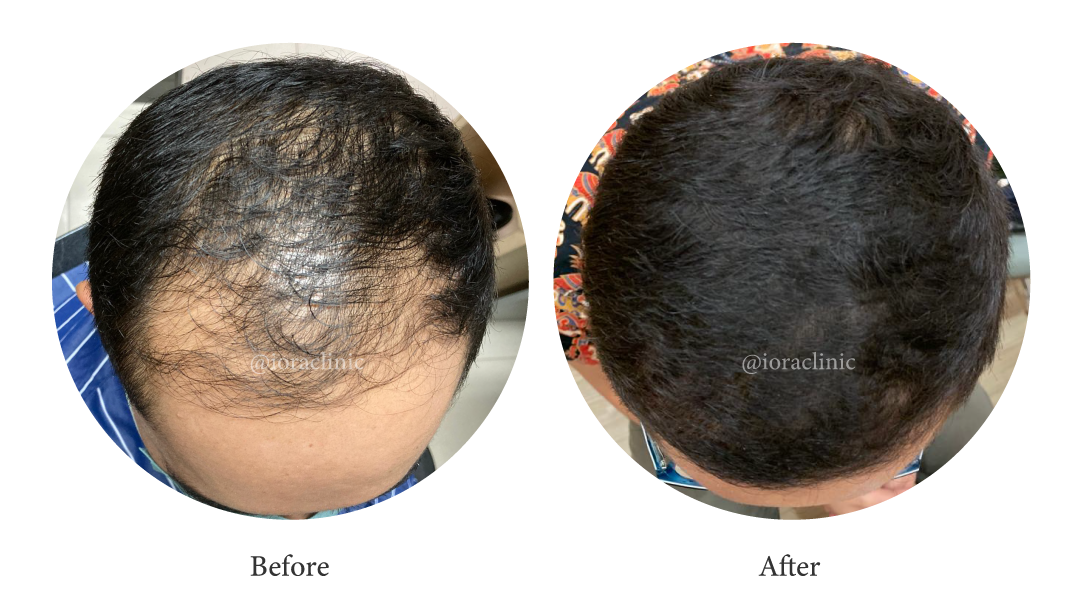 Rambut Rontok Normal atau Hormonal? Kenali Perbedaanya - Colederma