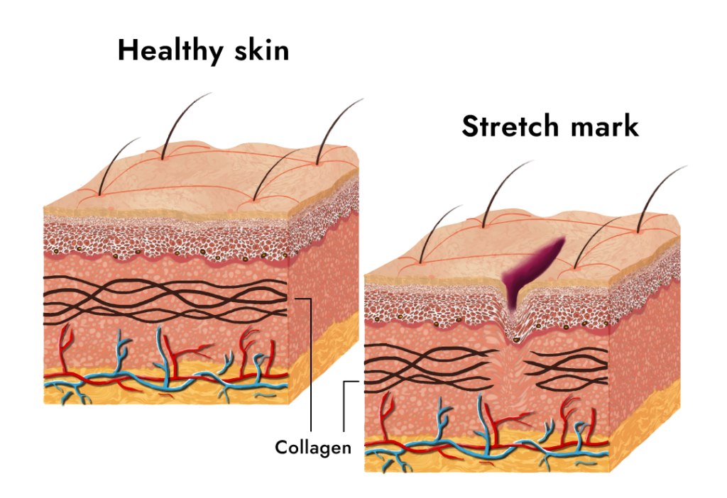 Stretch Mark - Causes, Prevention, and Treatment - Colederma